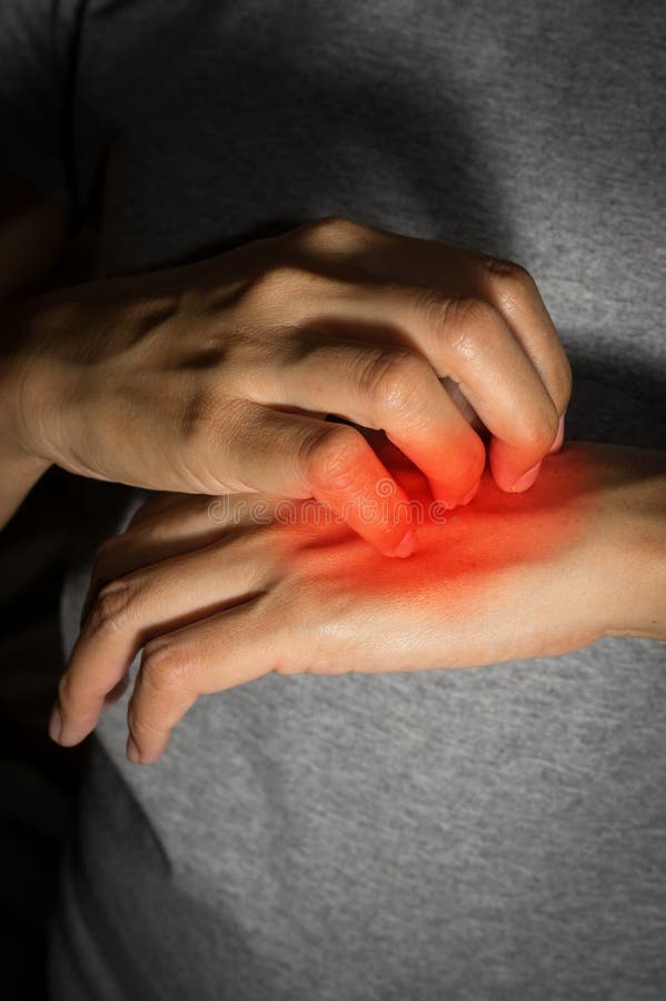 Woman Scratching Hand Skin. Stock Photo - Image of sick, allergen: 99690578