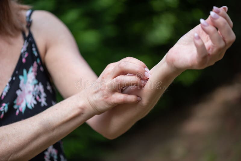 Woman scratching her arm stock photo. Image of sick - 181485112