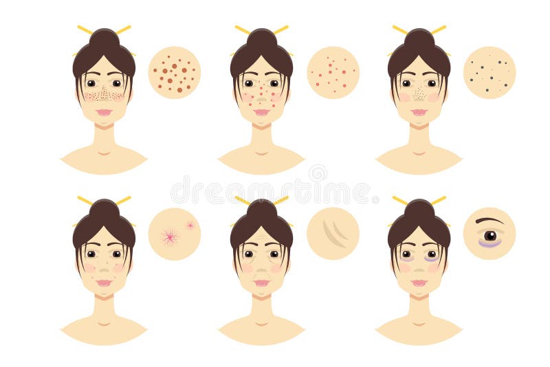 Woman with Skin Problem, Acne. Vector Stock Vector - Illustration of ...