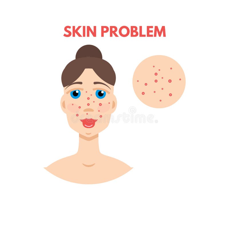 Woman with Skin Problem. Vector Stock Vector - Illustration of ...