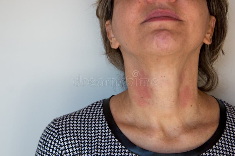 Hives On Neck And Face