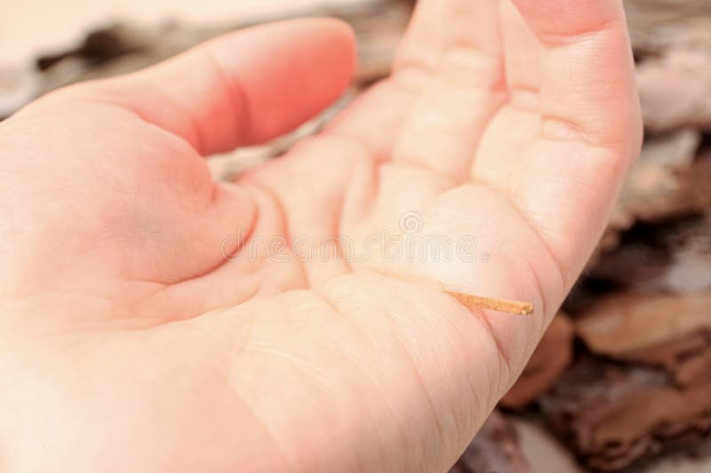 Woman with Splinter in Her Hand Outdoors, Closeup Stock Photo - Image ...
