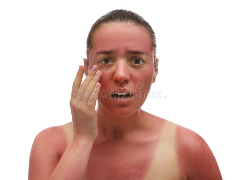Woman with Sunburned Skin on White Background Stock Photo - Image of ...