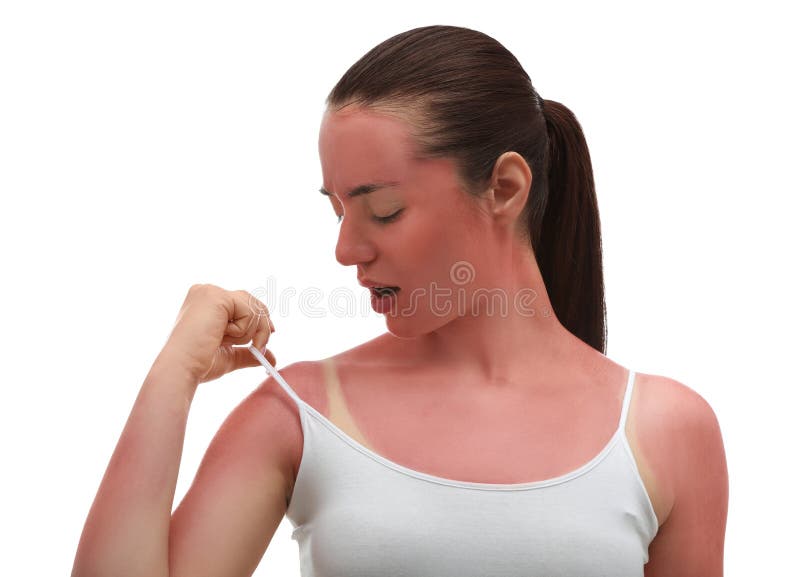Woman with Sunburned Skin at Home Stock Photo - Image of mark ...