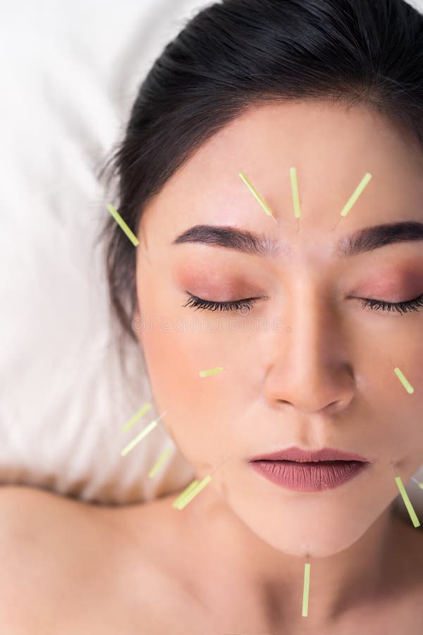 Woman Undergoing Acupuncture Treatment on Face Stock Photo - Image of ...