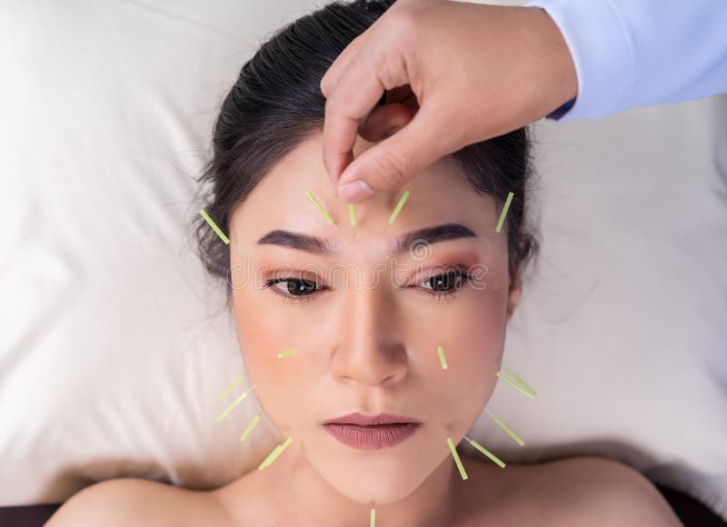 Woman Undergoing Acupuncture Treatment on Face Stock Photo - Image of ...