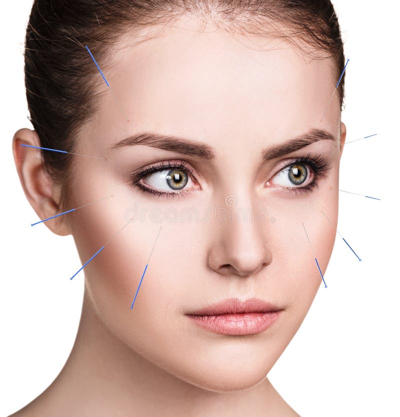 Woman Undergoing Acupuncture Treatment. Stock Image - Image of ...