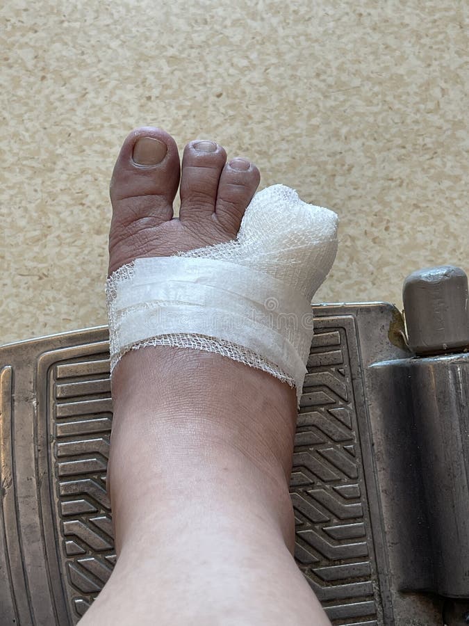 A Woman Wears a Cast on Her Leg because of a Broken Finger Bone. Stock ...