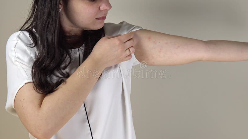 Itchy Allergic Insect Bite On A Bare Female Leg Stock Video Video Of