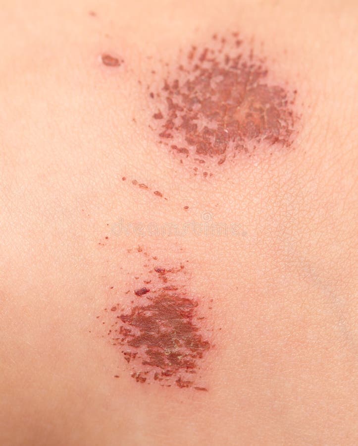 Droge wond op knie stock foto. Afbeelding bestaande uit ongeval - 49316240