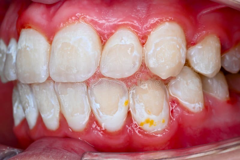 Orthodontist S Work on a Mouth Close-up Stock Image - Image of teeth ...