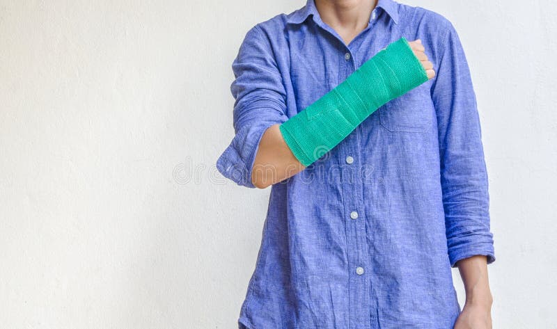 Worker Woman Accident on Arm with Green Cast Stock Image - Image of ...