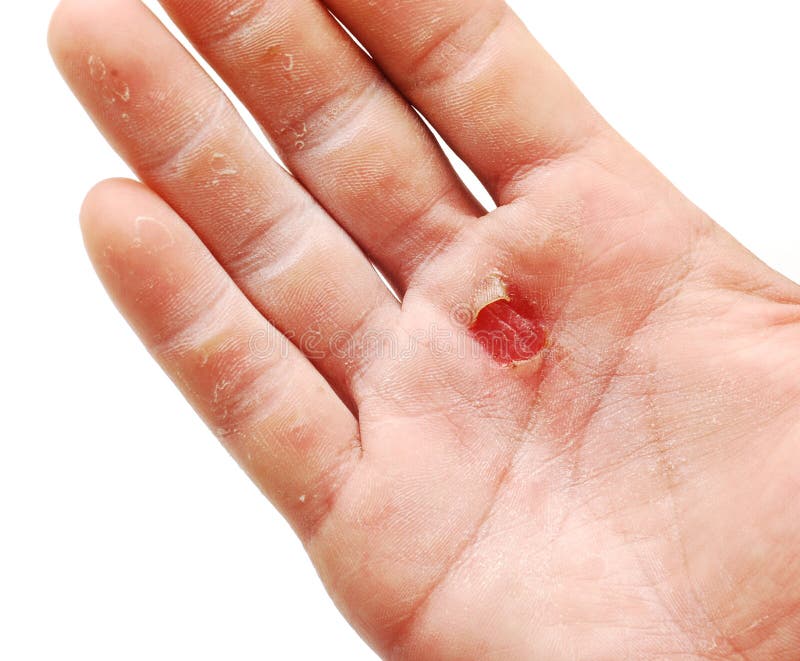 Wound stock photo. Image of pain, damage, injured, injury - 20378800