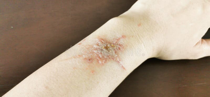 Wound on arm from Insect stock photo. Image of medical - 199915004