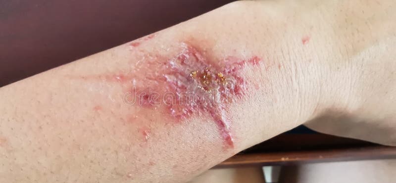 Wound on arm from Insect stock image. Image of allergy - 199914999