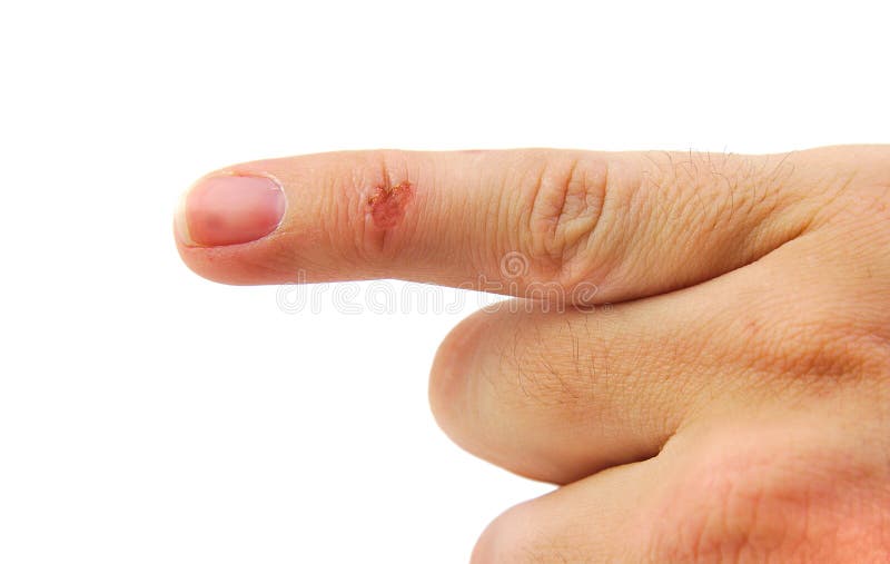 Man Has Pain In Pinky Finger Stock Image - Image of pain, discomfort ...