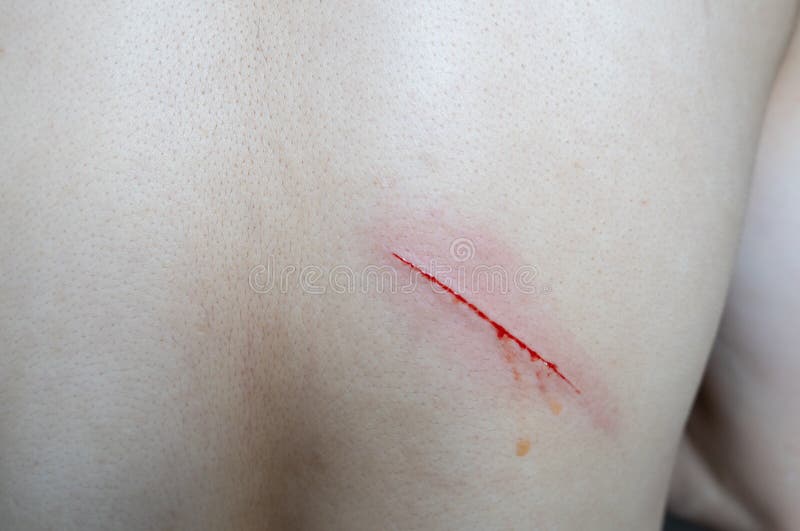The Wound on the Back, Bleeding Red Stock Image - Image of open, trauma ...
