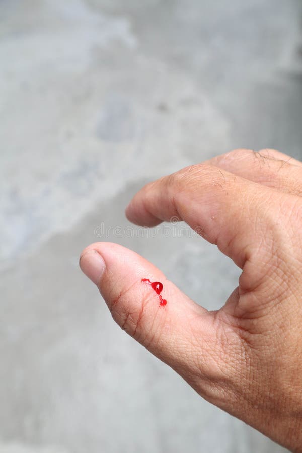 Wound on the Back of His Right Finger Was Bleeding. Stock Photo - Image ...