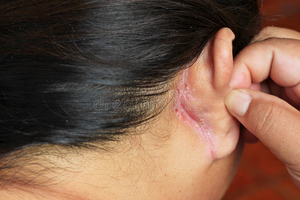 Wound behind ear stock image. Image of deaf, tinnitus - 93319467