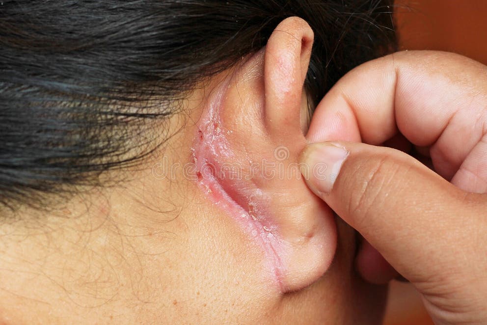 Wound behind ear stock photo. Image of health, infections - 93319812
