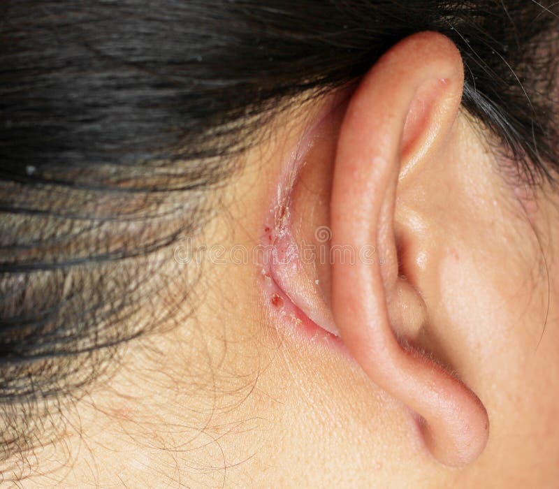 Wound behind ear stock image. Image of blood, help, wound - 93319821