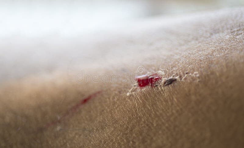 The Wound is Bleeding on the Human Skin Stock Photo - Image of furrow ...