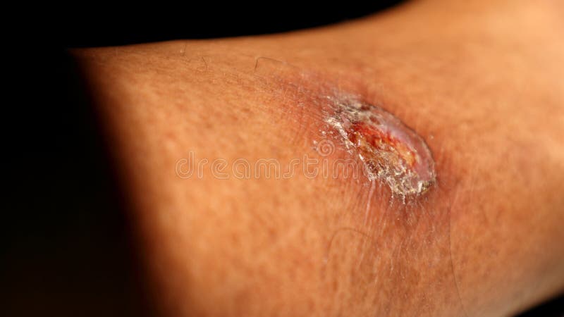 Wound caused by scratching stock photo. Image of dermatology - 235244976