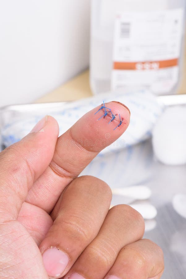 Stitch wound. stock photo. Image of hospital, health - 43444602