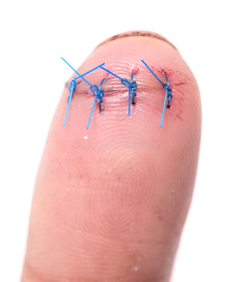 Wound stock image. Image of hospital, incision, flesh - 65339257