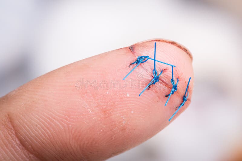 Wound stock image. Image of stitch, injure, scar, hurt - 65339381