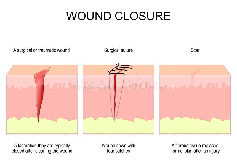 Laceration Injury Stock Illustrations – 320 Laceration Injury Stock ...