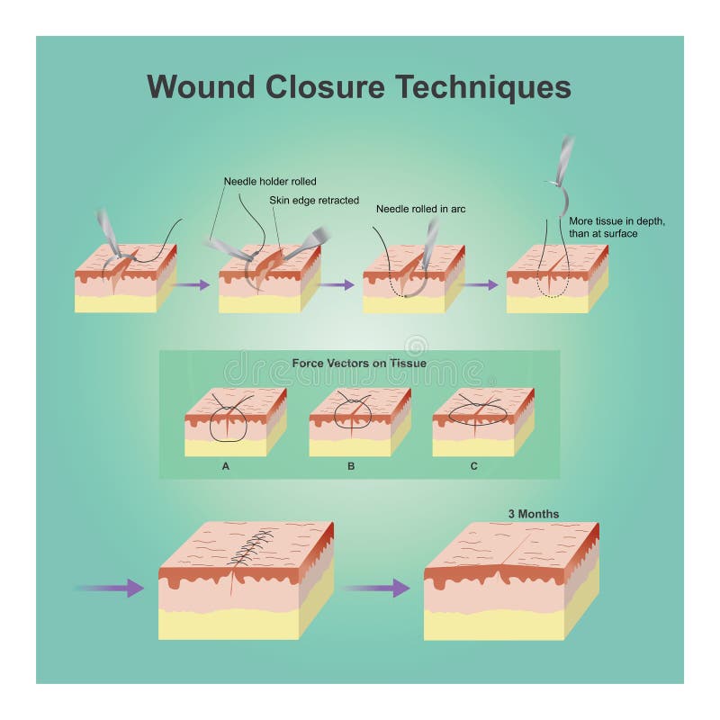 Healing by first intention stock vector. Illustration of anatomy - 54257212