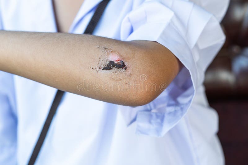Bleeding Elbow Stock Photos - Download 69 Royalty Free Photos