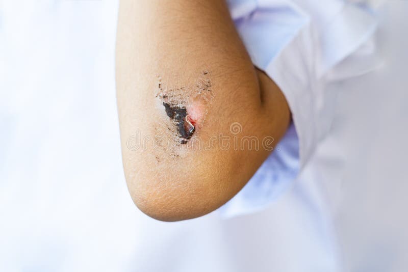 Wound Scab Stock Photos - Download 804 Royalty Free Photos