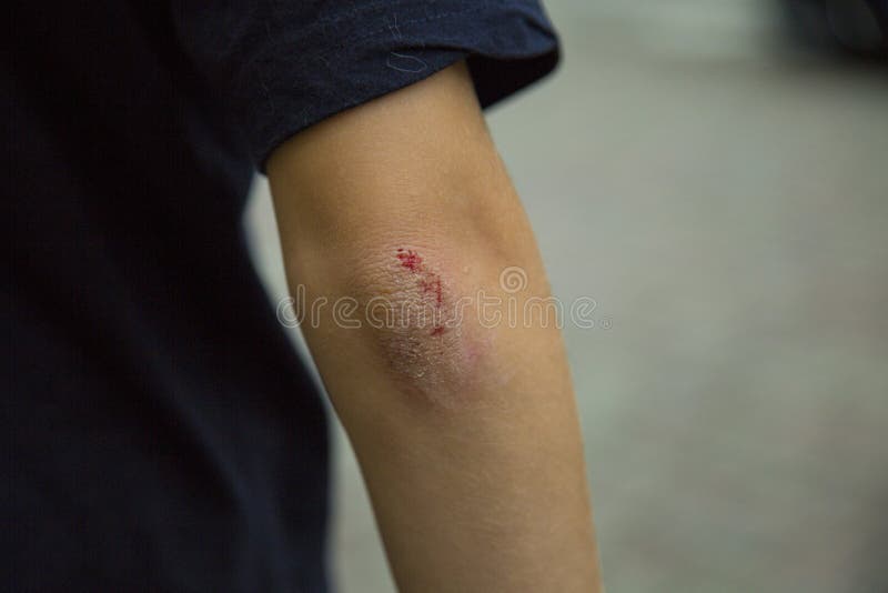 Scraped elbow #1 stock photo. Image of pain, scratch, skin - 6777262