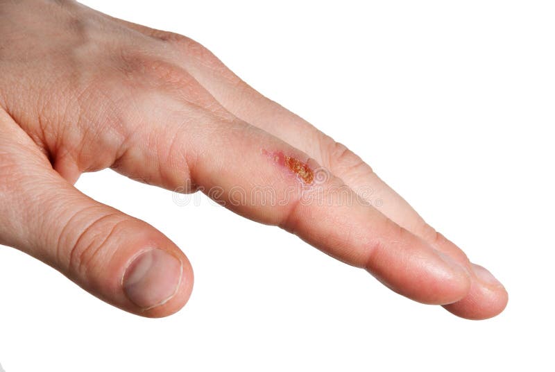 Wound at a finger stock image. Image of aching, breach - 29460657