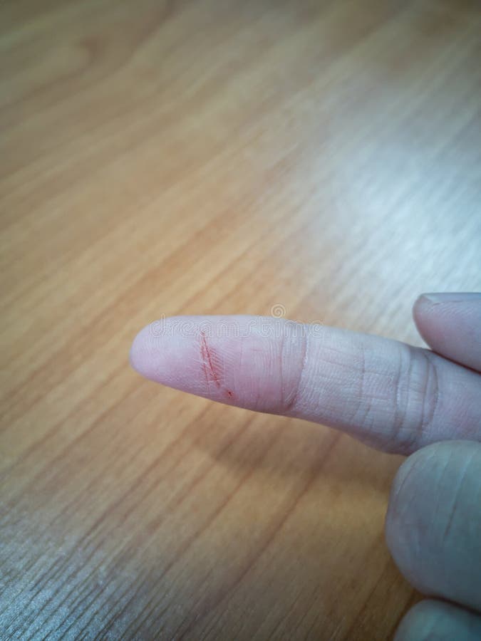 Wound on a Finger Caused by a Cut Stock Photo - Image of bleed, nail ...