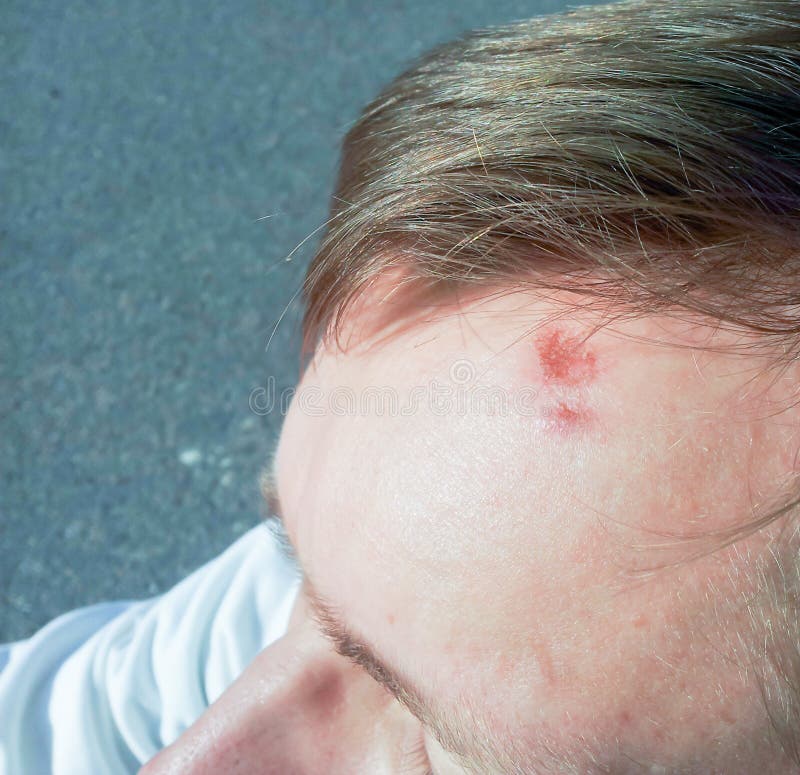 Wound on forehead stock photo. Image of scar, healthcare - 32028246