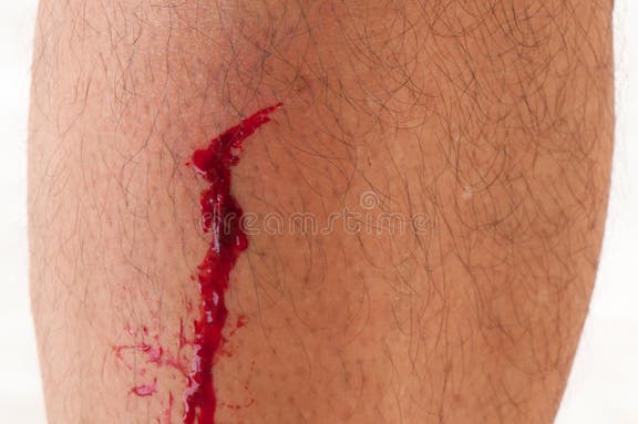 Wound fresh wounds stock image. Image of nasty, body - 77767293