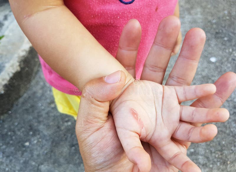 Wound in the Hand of a Child from an Iron Burn in Father`s Hand. Stock ...
