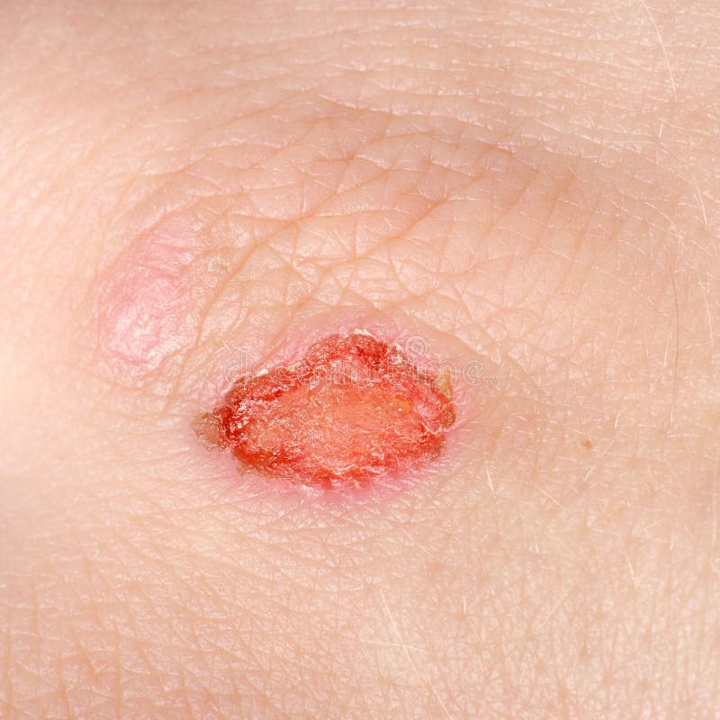Wound stock photo. Image of infected, injury, close, patient - 58998336