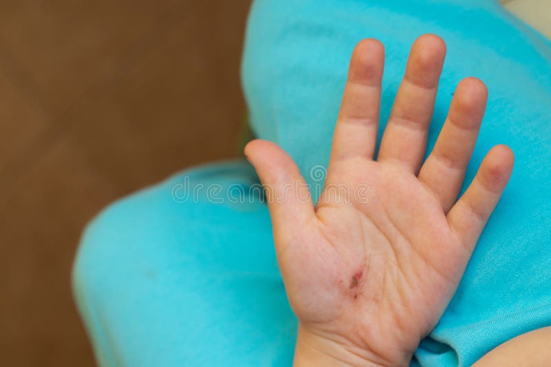 A Wound on the Hand of a Little Boy after Falling Stock Image - Image ...