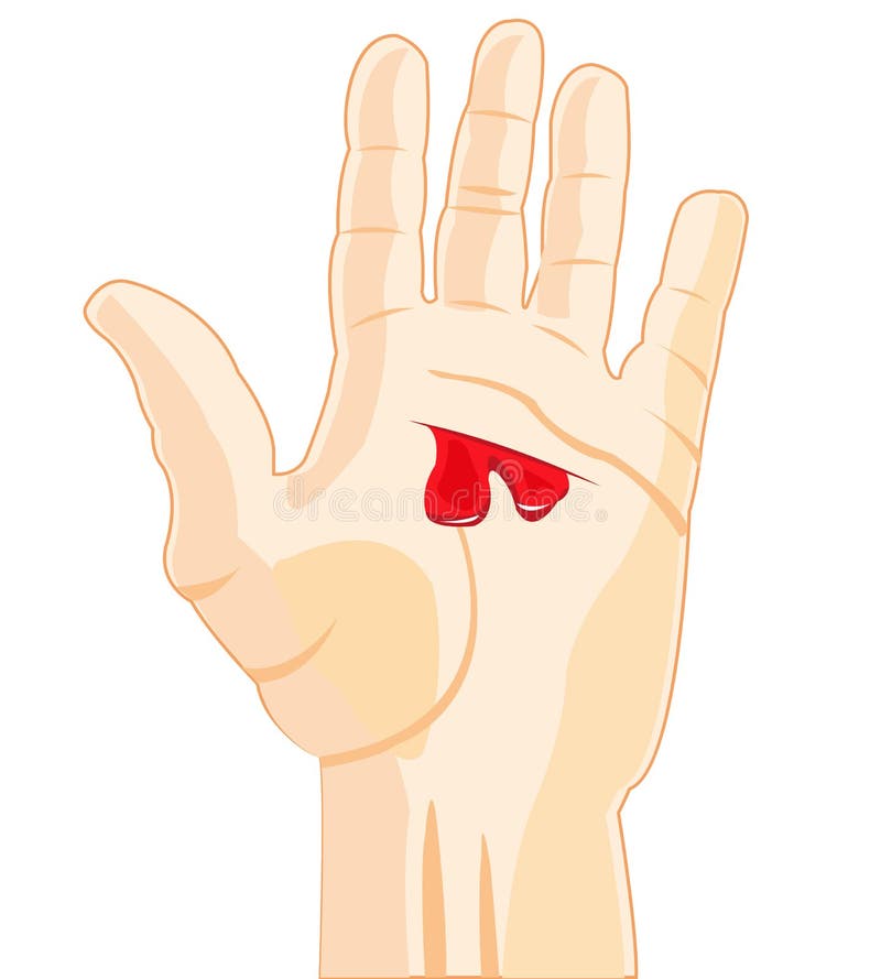 Hand Person Wound Stock Illustrations – 886 Hand Person Wound Stock ...