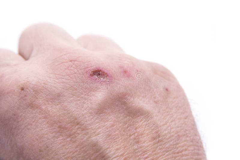 Scar Wound Of Hand Injury Isolated On White Background Stock Image ...