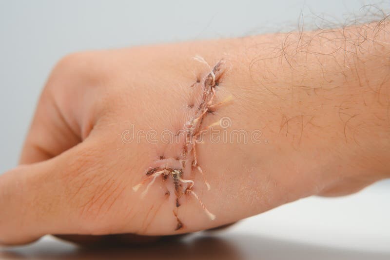 Wound Hand, Suturing the Wound. the Type of Cut after Surgery Stock ...