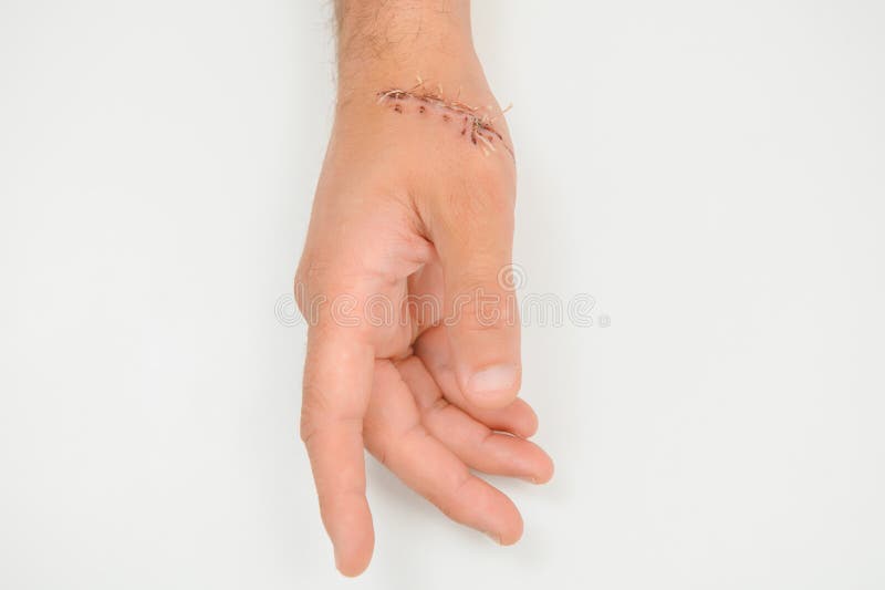 Wound Hand, Suturing the Wound. the Type of Cut after Surgery Stock ...