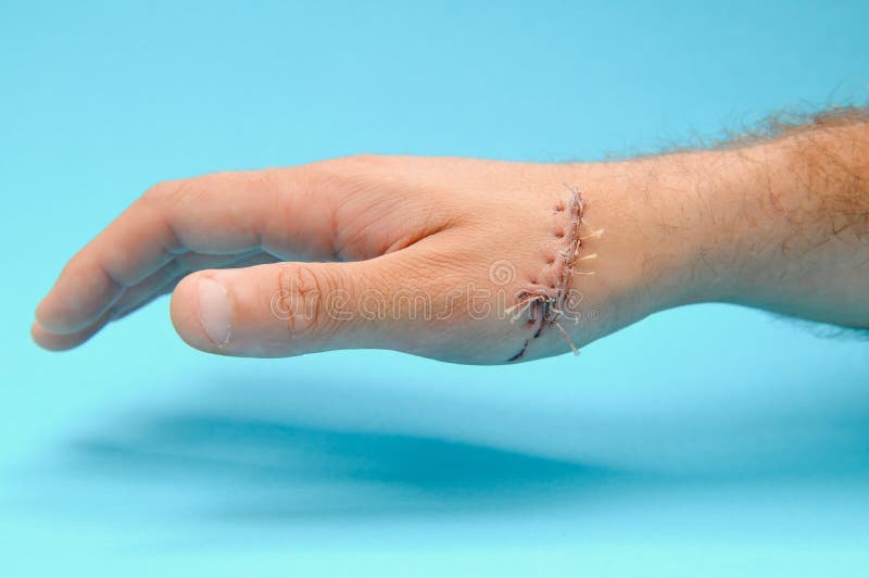 Wound Hand, Suturing the Wound. the Type of Cut after Surgery Stock ...