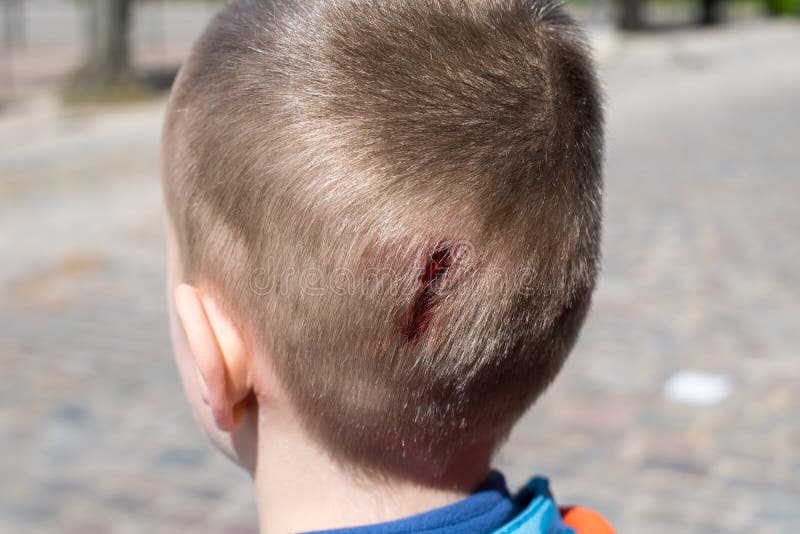 Wound on head injury stock photo. Image of scalp, unconscious - 56209184