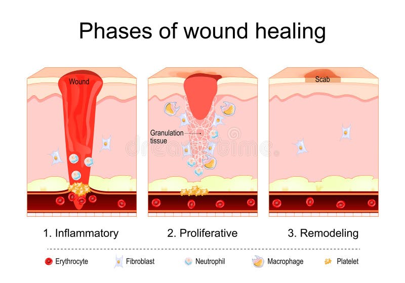 Wound Healing Process. Tissue Repair Stock Vector - Illustration of ... Wound Healing Process. Tissue Repair Stock Vector - Illustration of ...