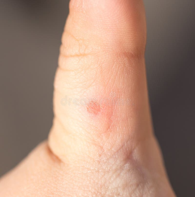 Wound on his finger. macro stock photo. Image of clinic - 112106234